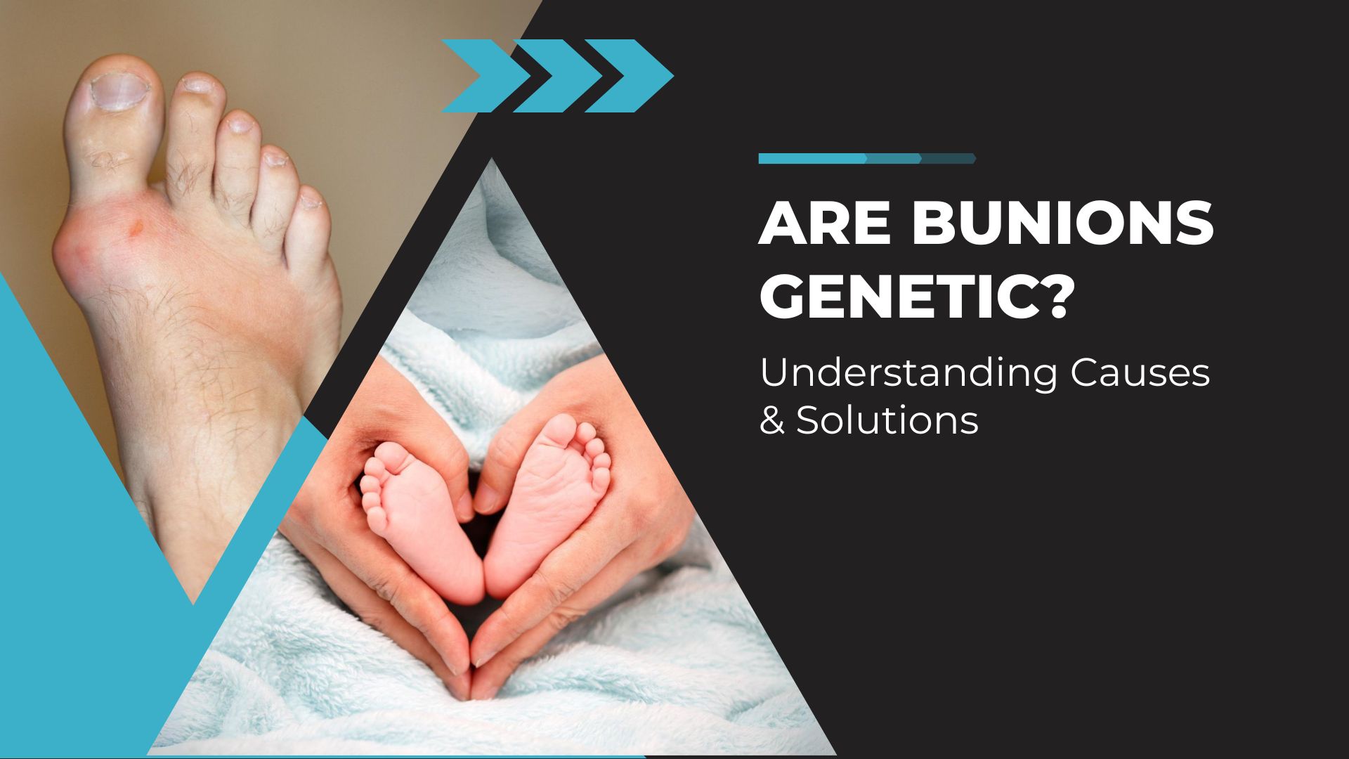 Are Bunions Genetic? Understanding Causes & Solutions